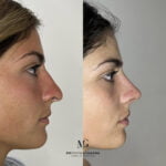 Rinoplastia Precio Argentina 2025 【Doctor Moyano Gauna】